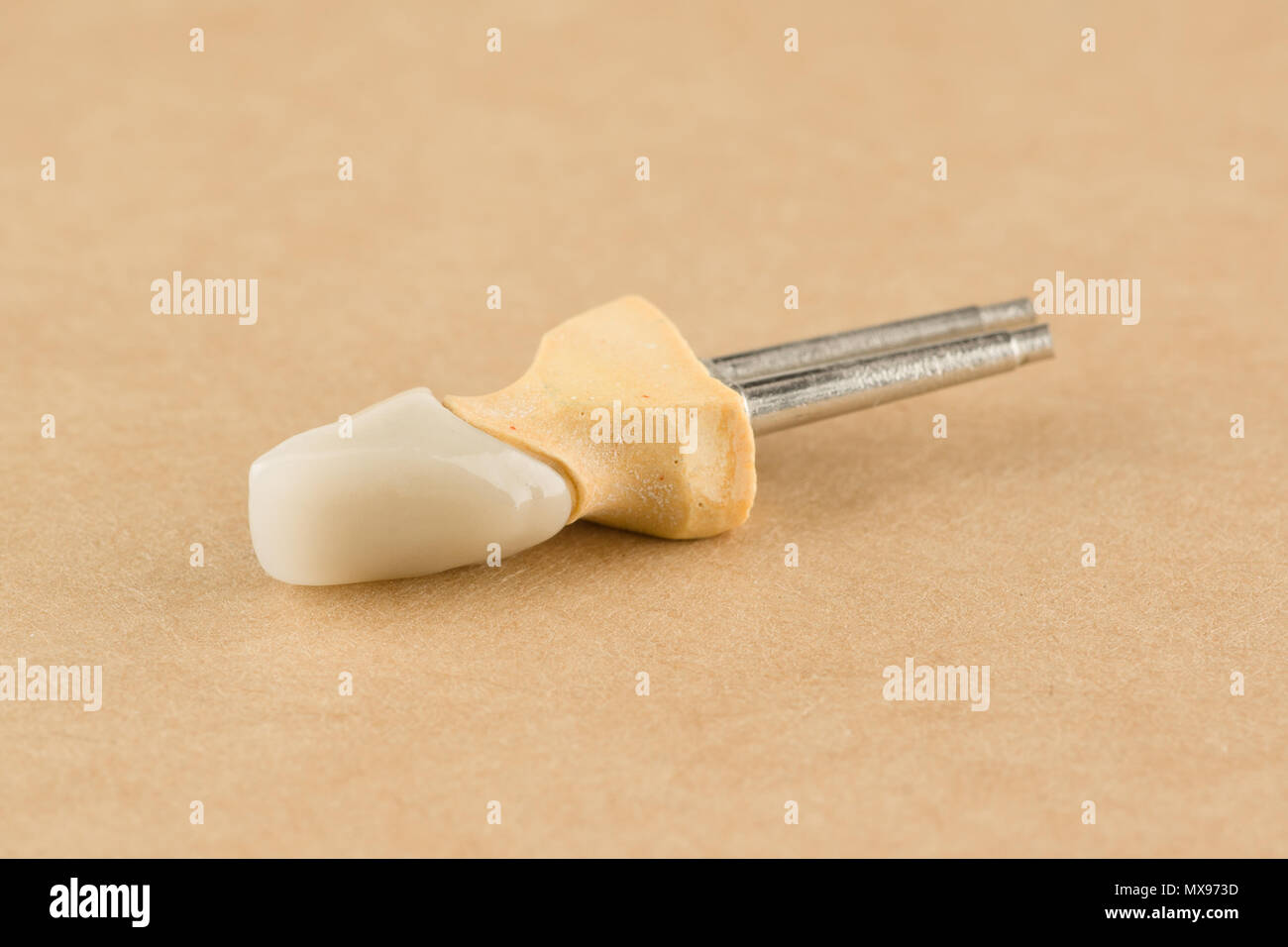 cast and cermet dental structures for restoration of teeth Stock Photo ...