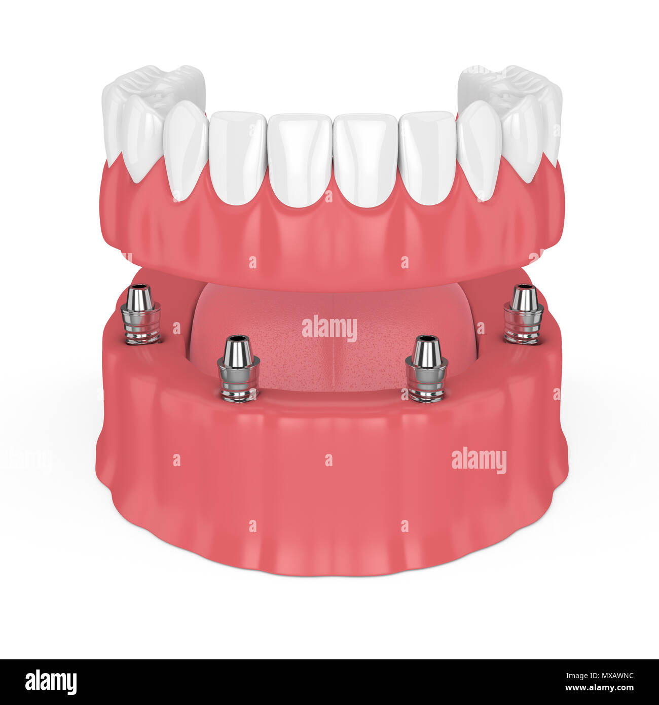 3d render of removable full implant denture isolated over white ...