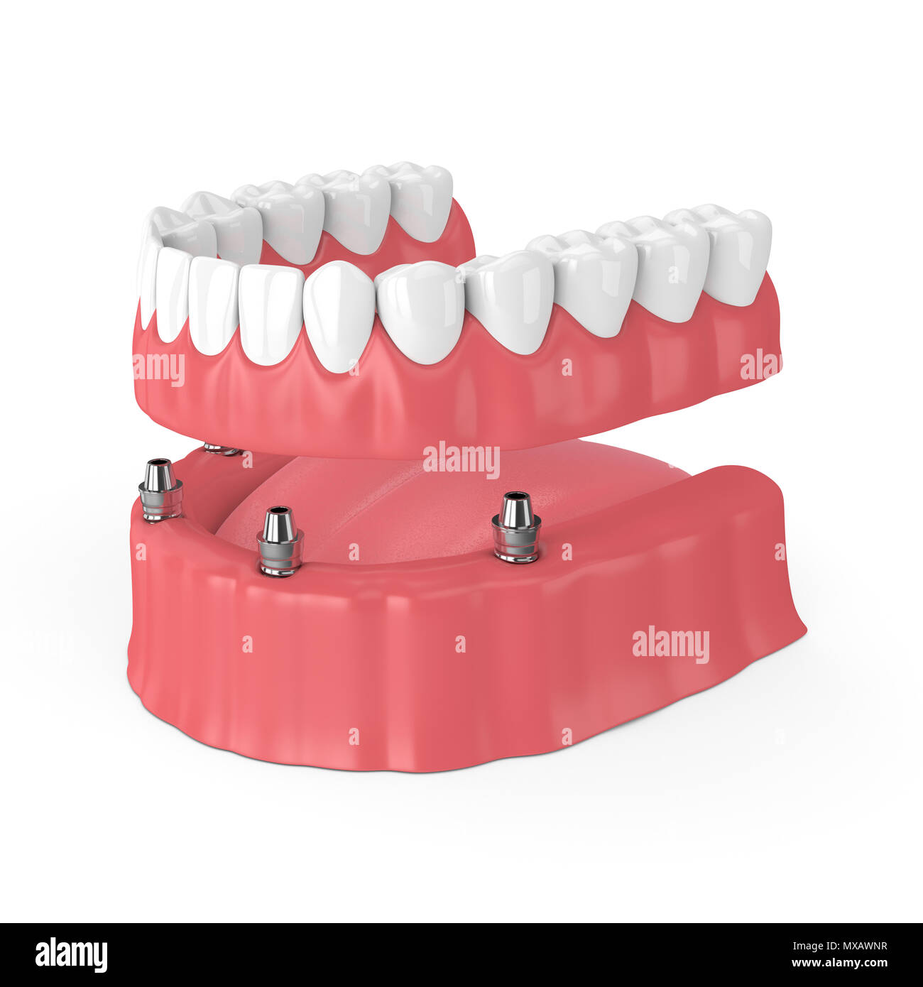 3d render of removable full implant denture isolated over white ...