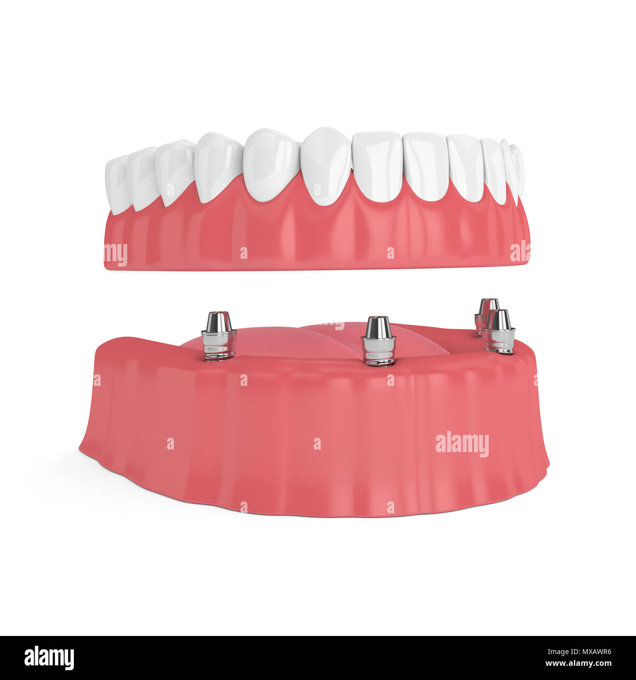 3d render of removable full implant denture isolated over white ...