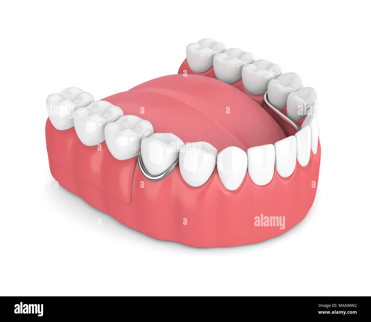 Removable Partial Dentures