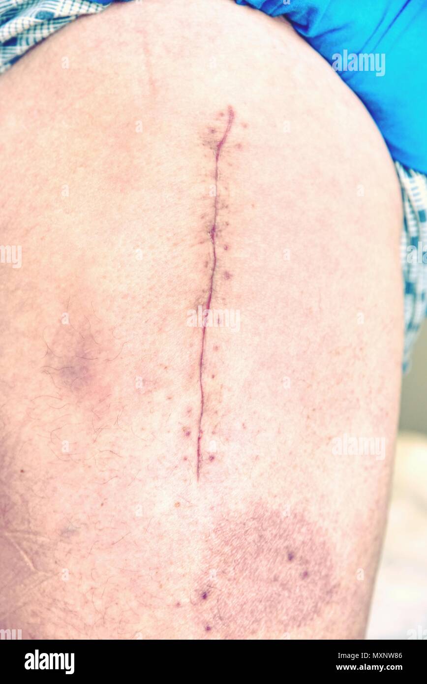 Incision Scar Stock Photos & Incision Scar Stock Images - Alamy