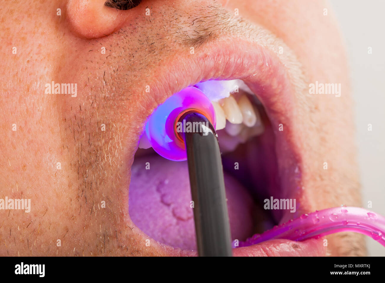 Dental treatment with polymerization lamp in oral cavity. Male patient ...