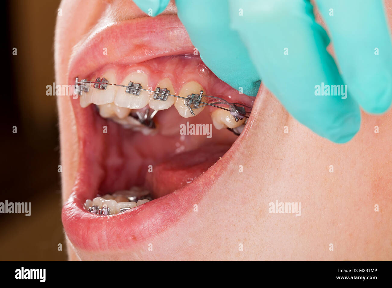 Wearing braces open mouth hi-res stock photography and images - Alamy