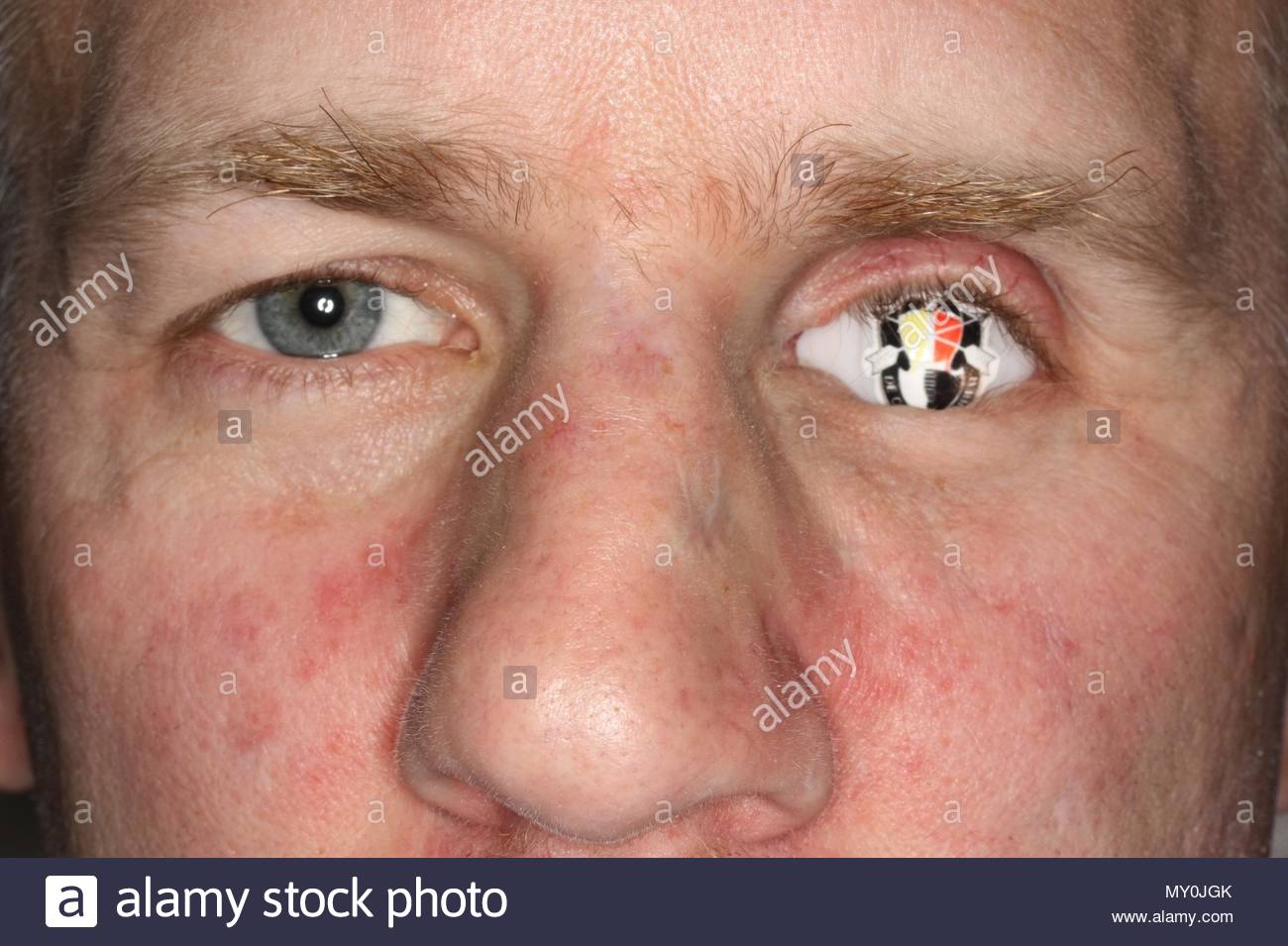 Prosthetic Eye Stock Photos & Prosthetic Eye Stock Images - Alamy