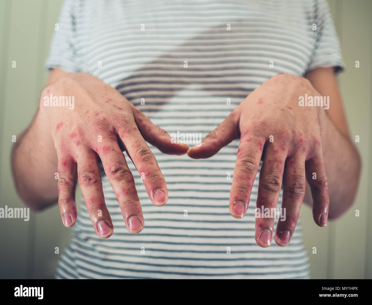 Sandpaper Rash On Hands And Feet at Ami Hernandez blog