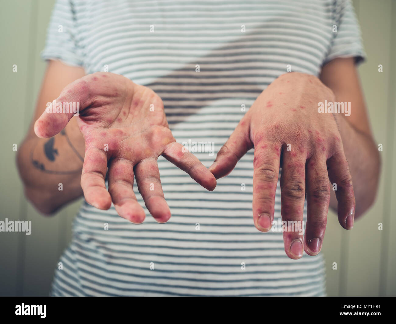 A young man is showing his hands with spots and rash from hand foot and ...