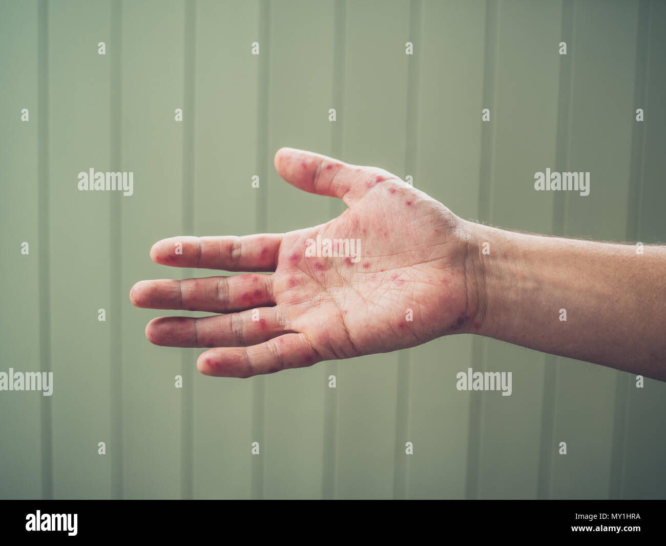 A young man is showing his hand with spots and rash from hand foot and ...
