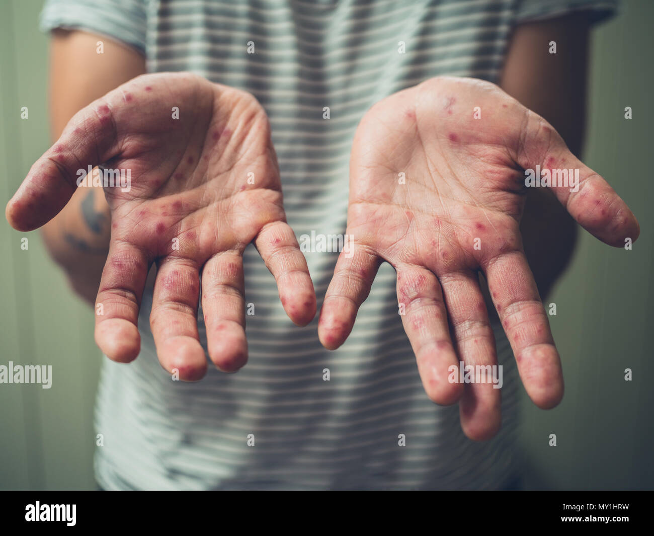 Hand mouth foot disease hi-res stock photography and images - Alamy