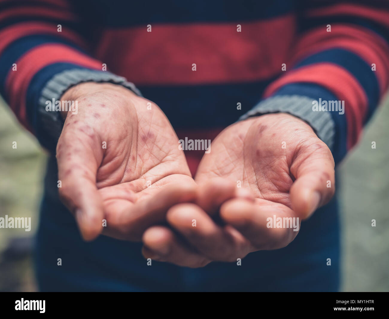 Rash on hands hi-res stock photography and images - Alamy