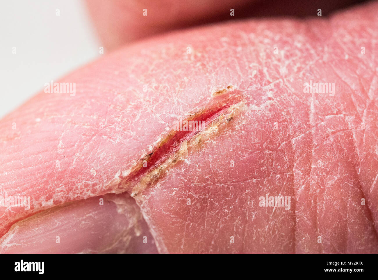 Painful Stitch High Resolution Stock Photography and Images - Alamy