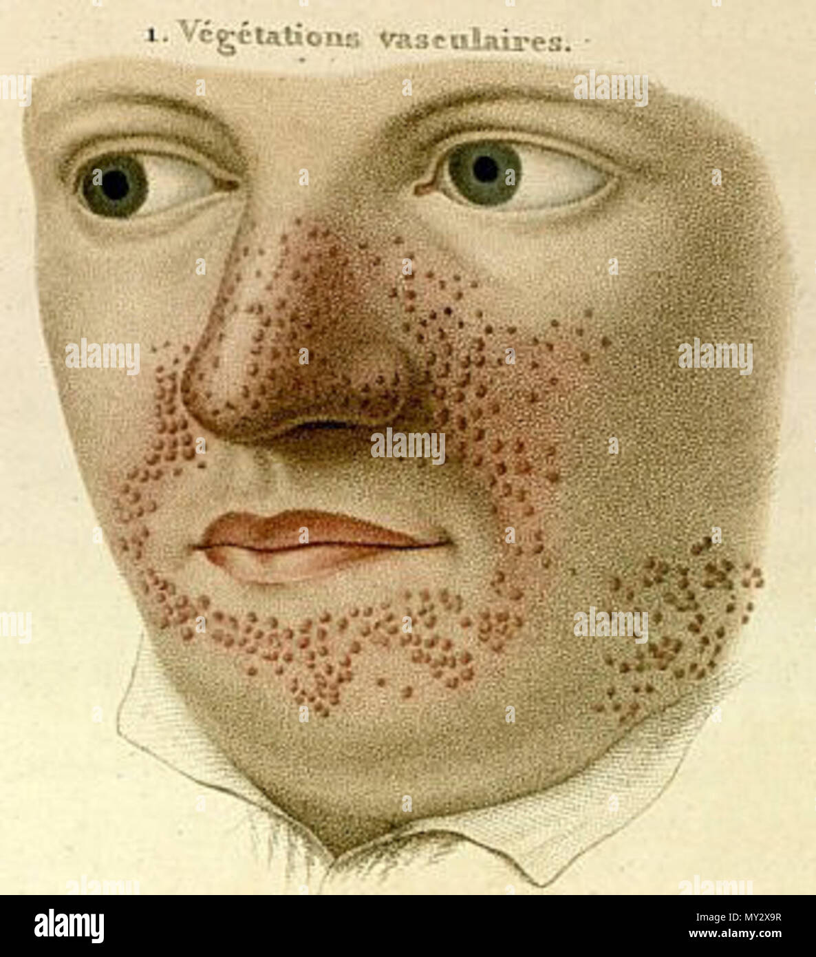 . English: The earliest illustration of tuberous sclerosis, with ...
