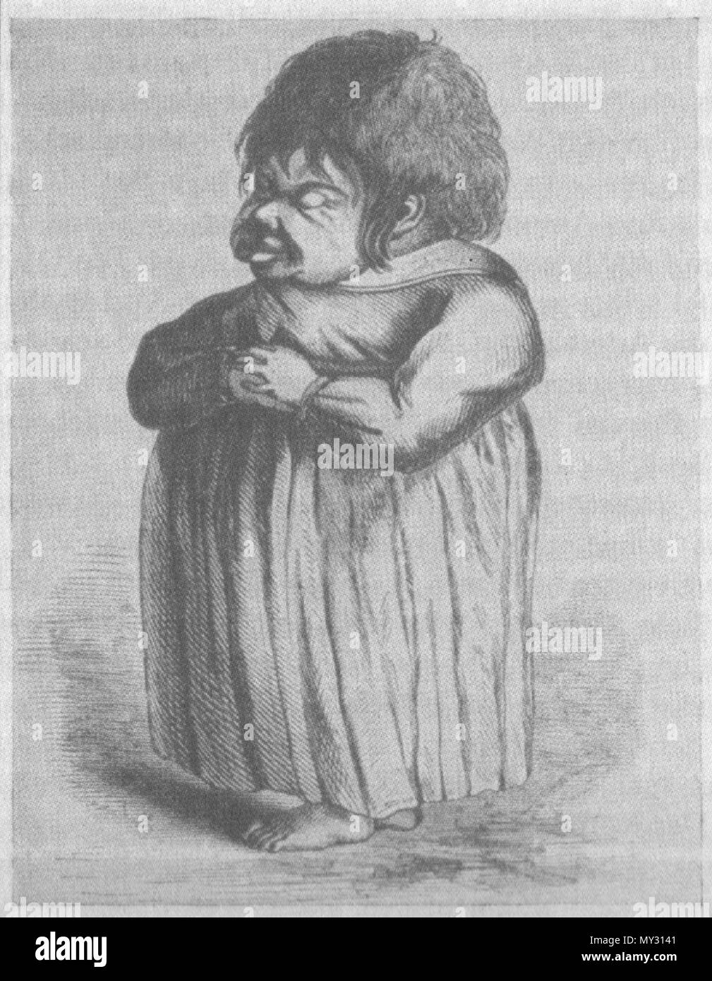 Cretinism hi-res stock photography and images - Alamy