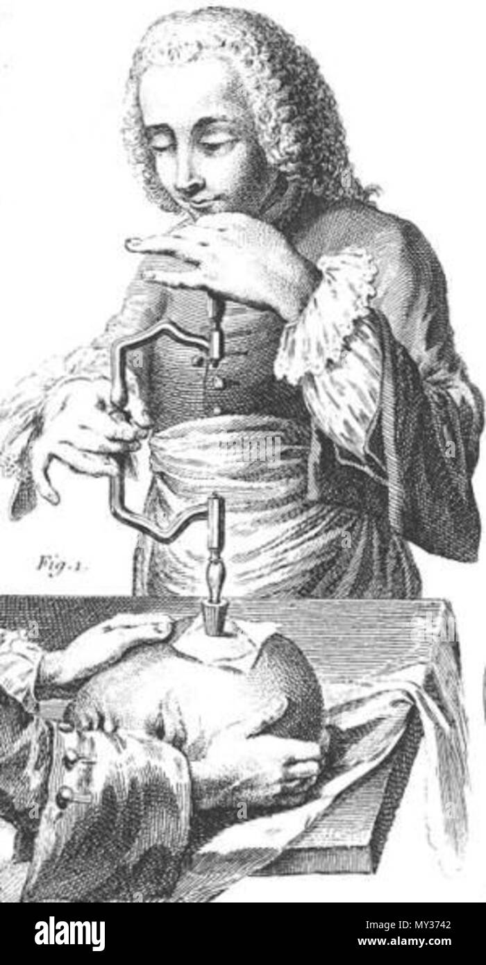 . Ilustración de una trepanación en Francia del siglo XVIII (L ...