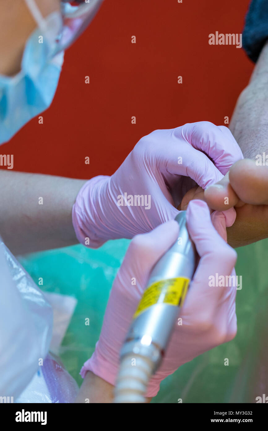 Professional hardware pedicure using electric machine.Patient on ...