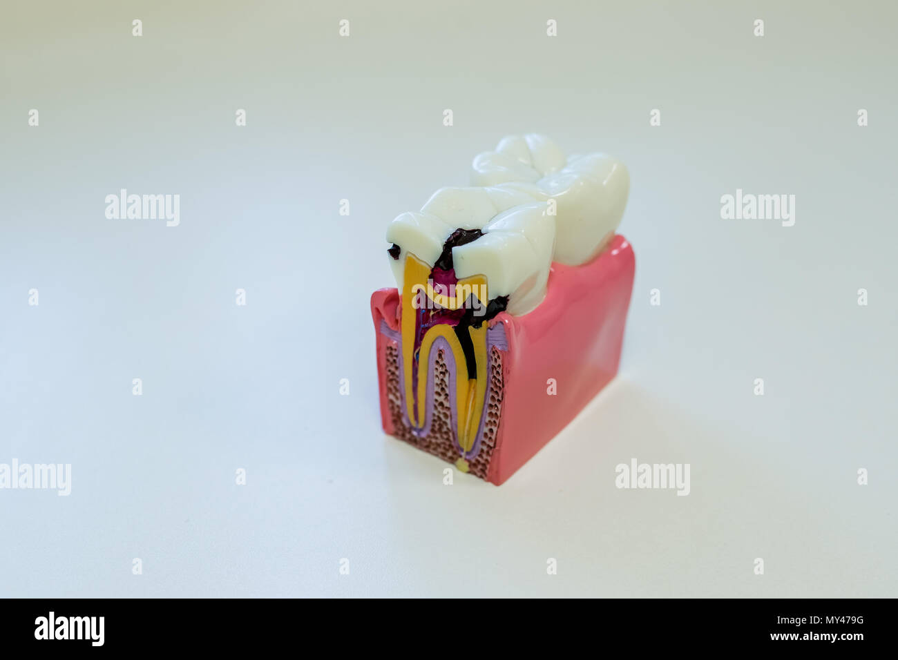 Tooth model for education in laboratory isolated. caries, tooth decay ...