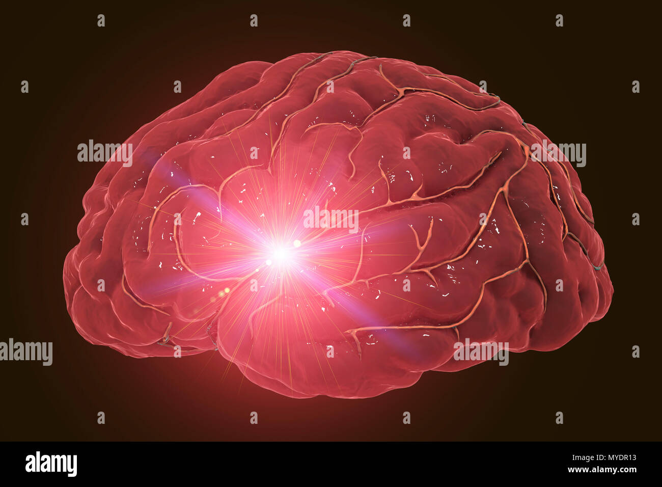 Stroke, computer illustration Stock Photo - Alamy