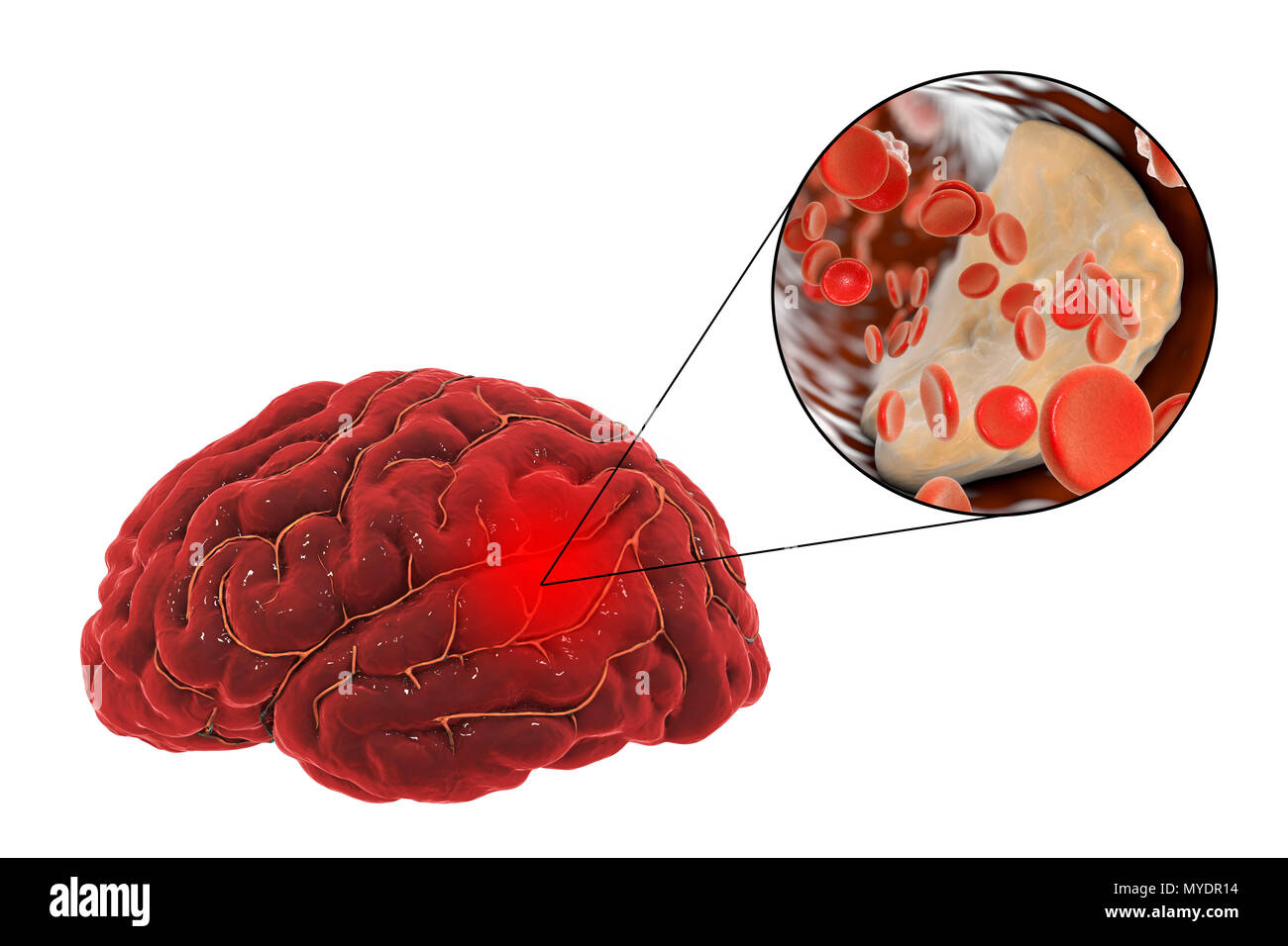 Stroke, computer illustration Stock Photo - Alamy