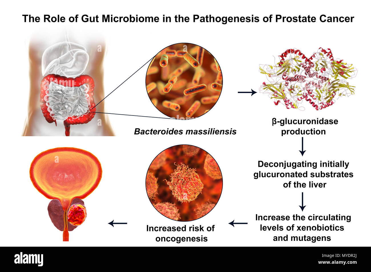 Gut microbiome and prostate cancer. Conceptual illustration showing the ...