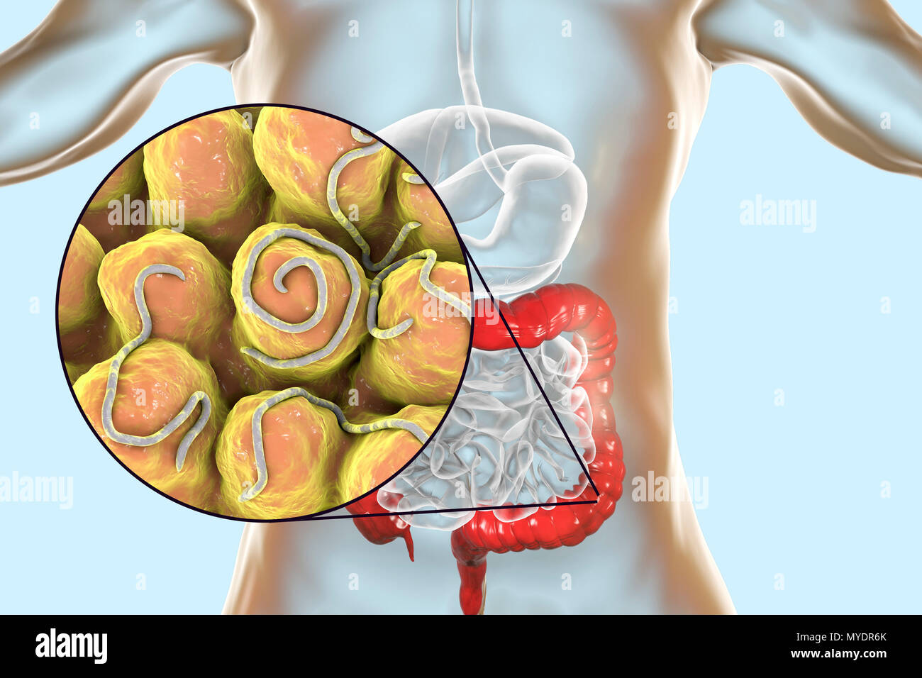 Bowel infection hi-res stock photography and images - Alamy
