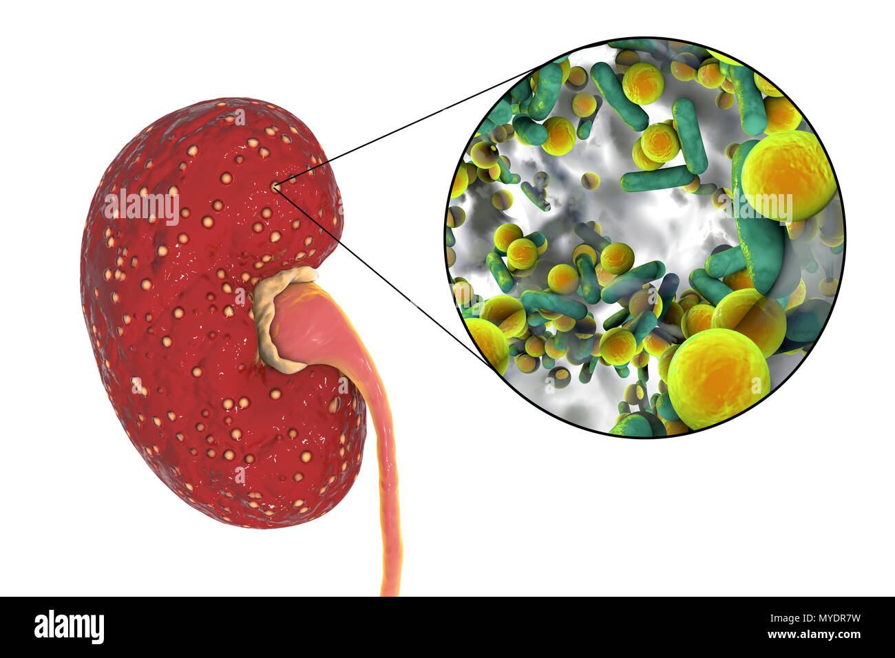 Acute pyelonephritis. Illustration of small abscesses (yellow) on the ...