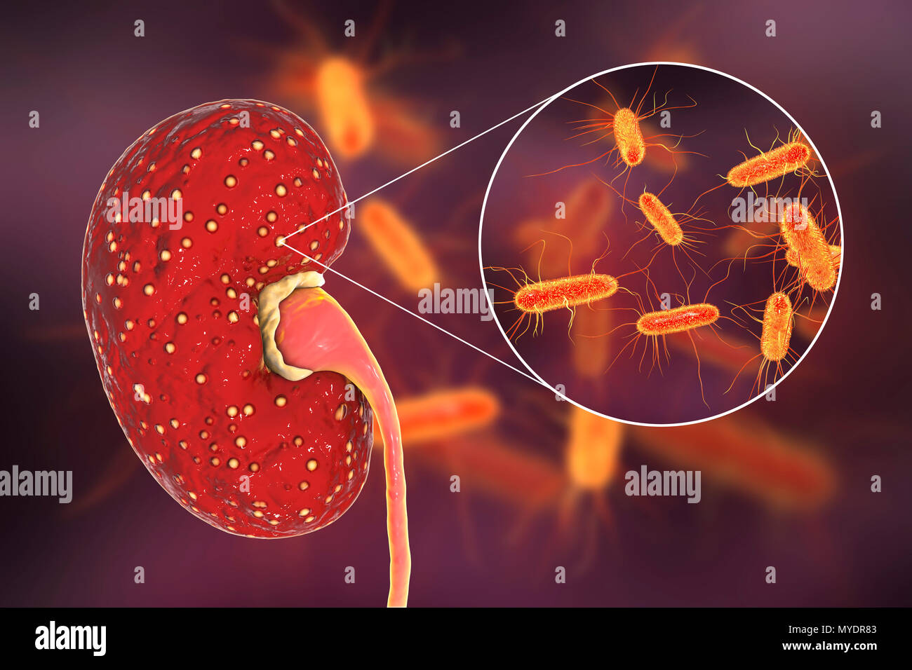 Abnormal urinary bladder hi-res stock photography and images - Alamy