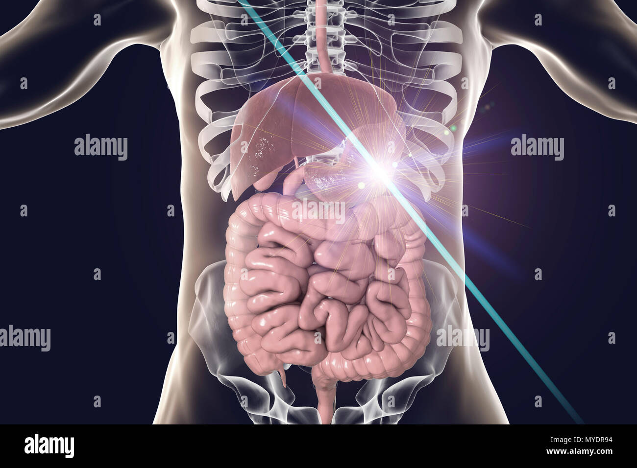 Laser surgery tumour hi-res stock photography and images - Alamy