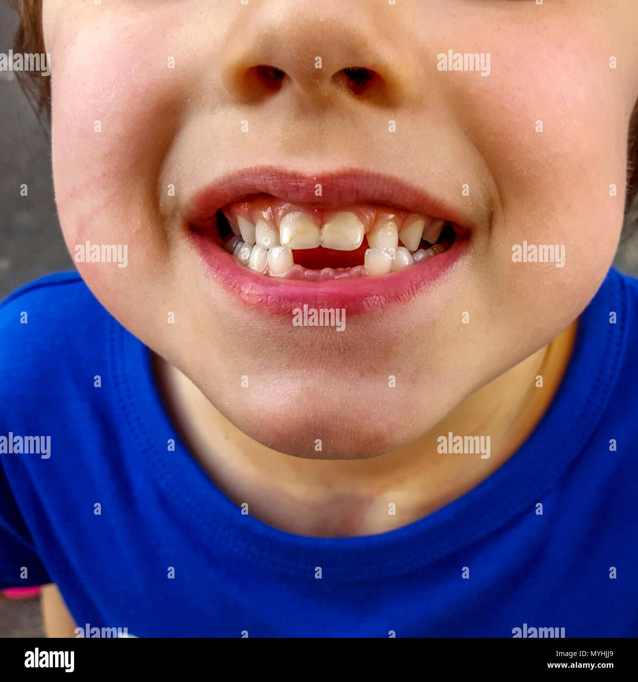 Young boy missing teeth Stock Photo - Alamy