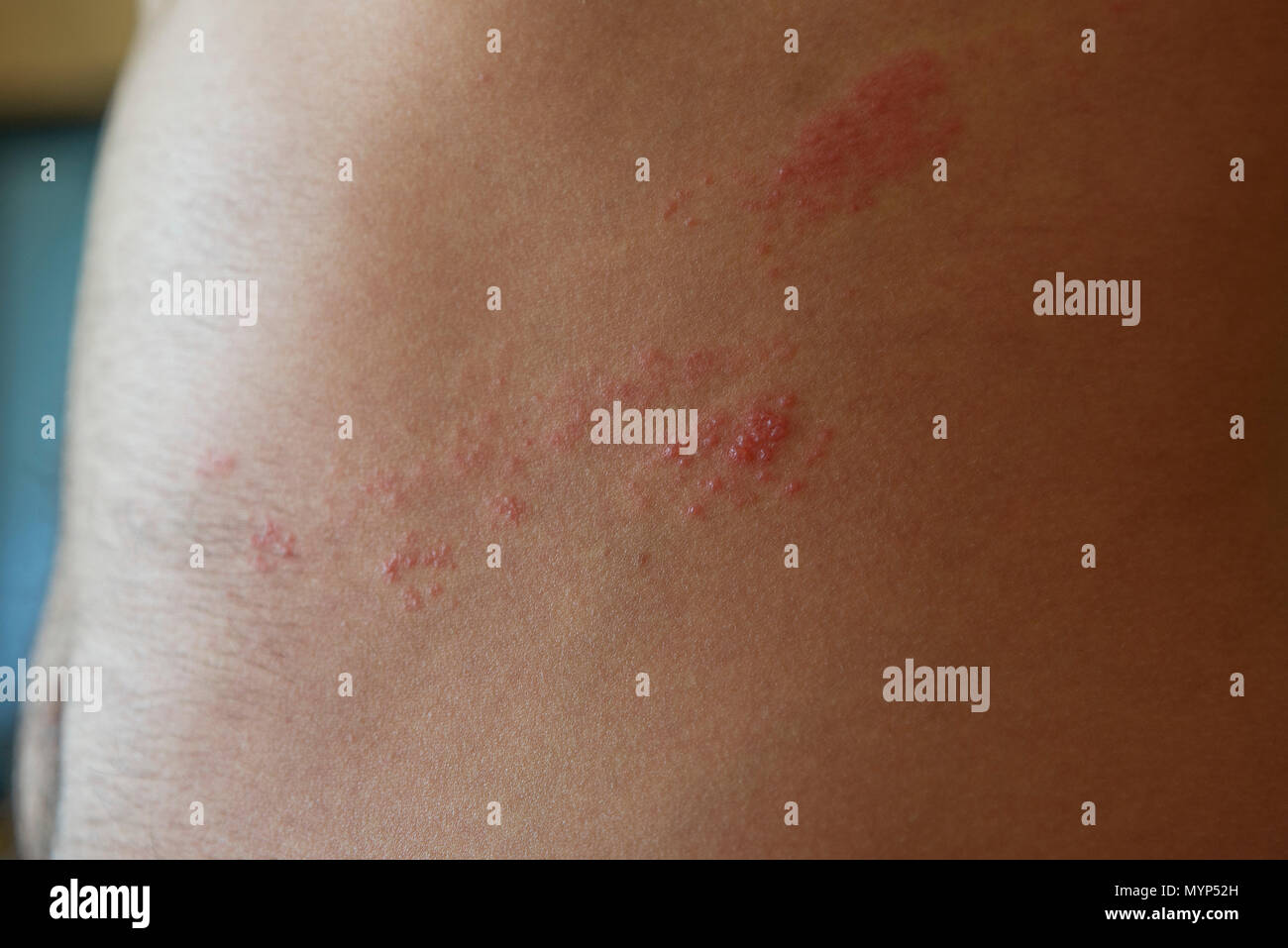 Welts hi-res stock photography and images - Alamy