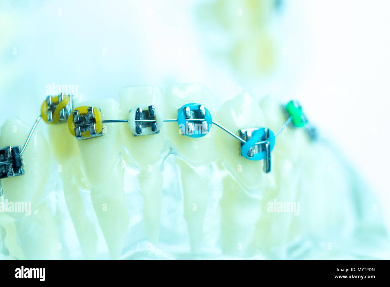 Dental metal braces teeth retainer aligners teaching orthodontics model ...