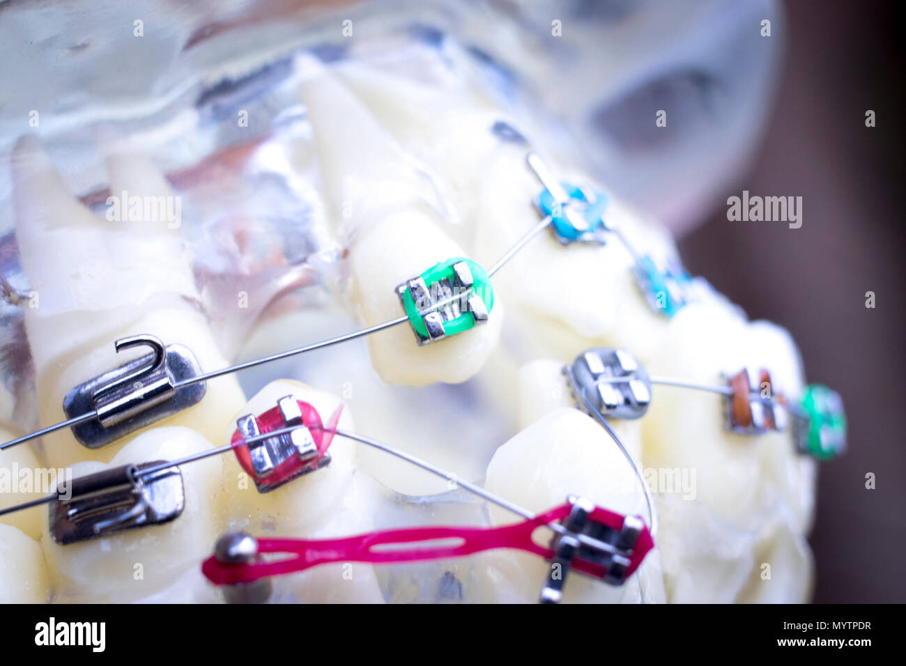 Dental metal braces teeth retainer aligners teaching orthodontics model ...