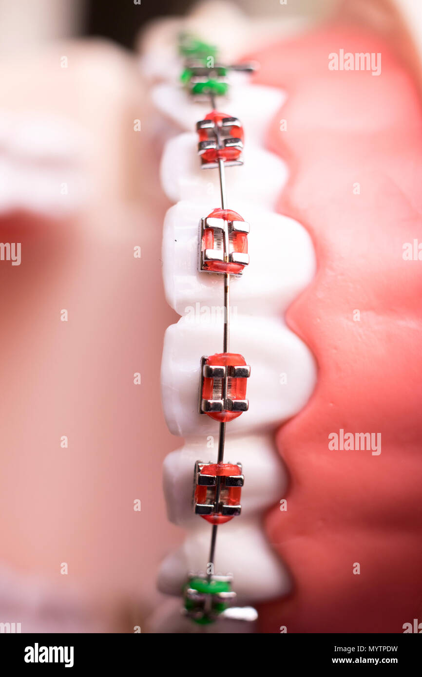 Dental metal braces teeth retainer aligners teaching orthodontics model ...