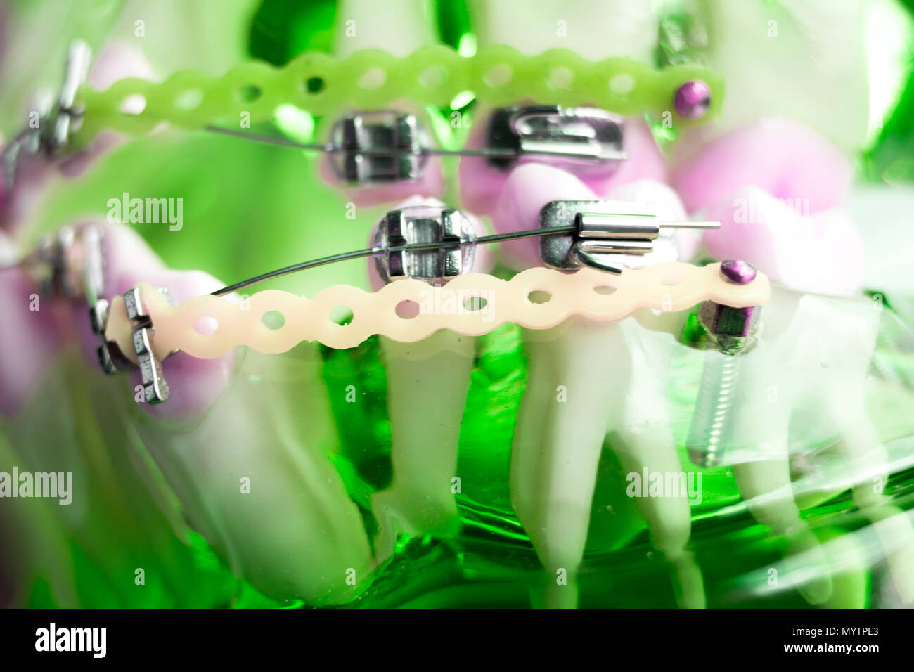 Dental metal braces teeth retainer aligners teaching orthodontics model ...