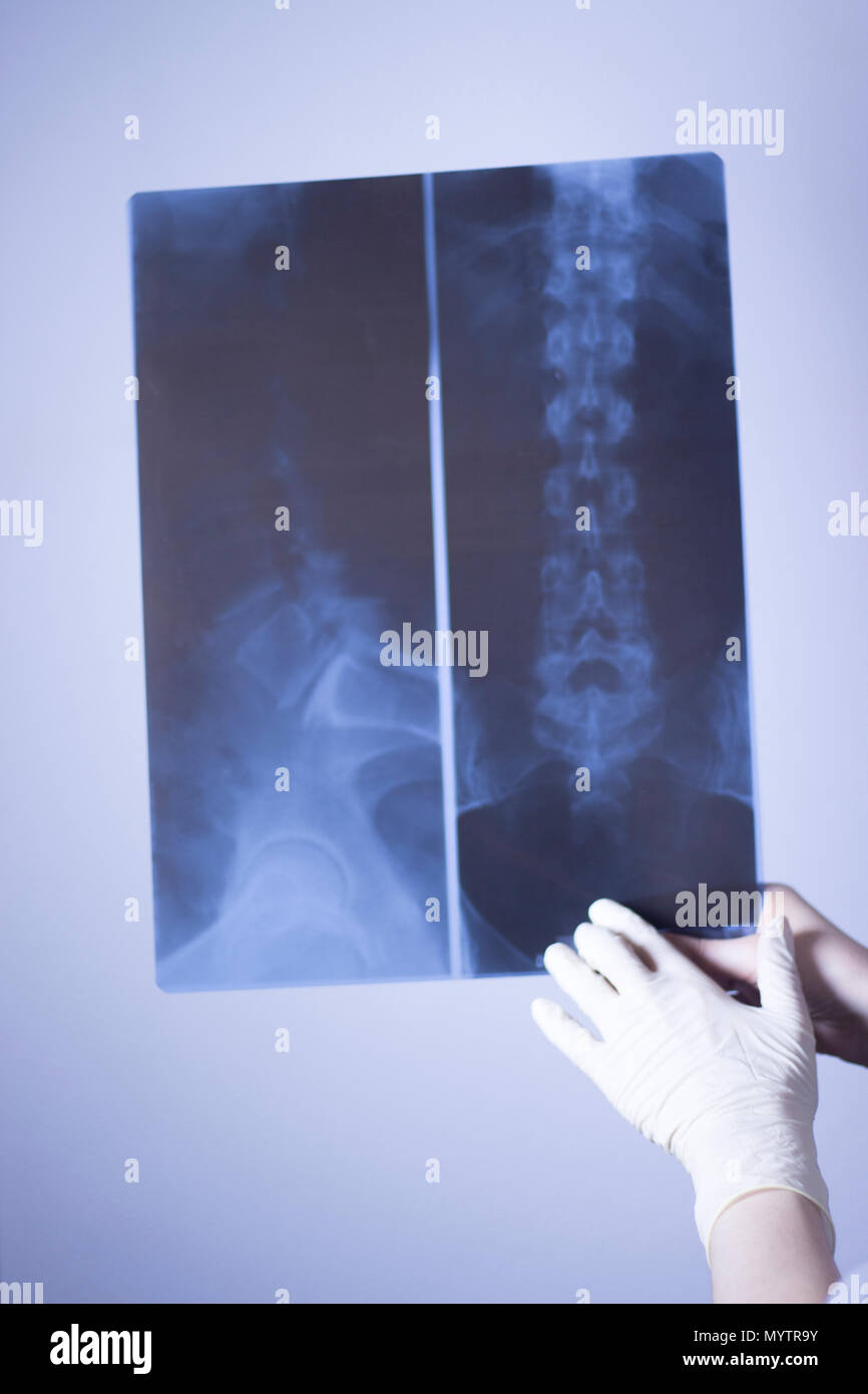 Medical hospital x-ray lowe back pain spine and hips traumatology scan ...