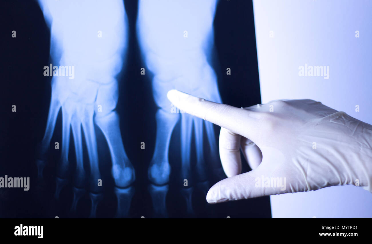 Medical hospital x-ray feet traumatology scan Stock Photo - Alamy