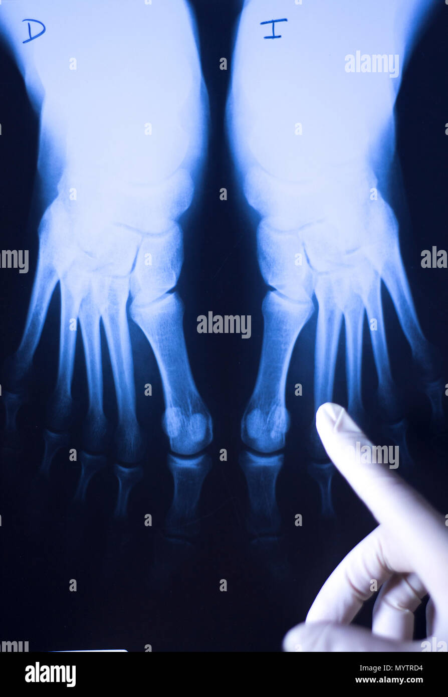 Medical hospital x-ray feet traumatology scan Stock Photo - Alamy