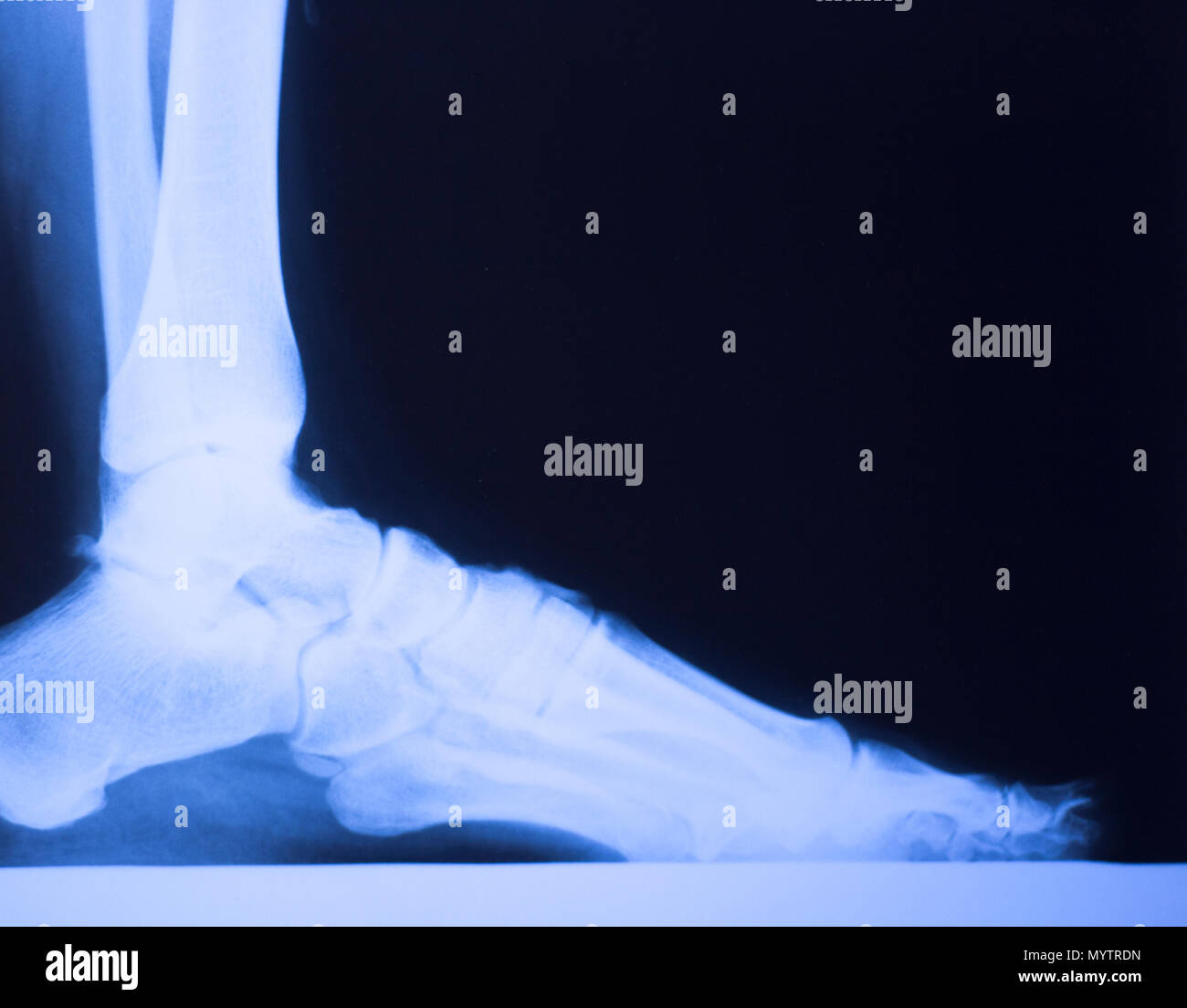 Medical hospital x-ray feet traumatology scan Stock Photo - Alamy