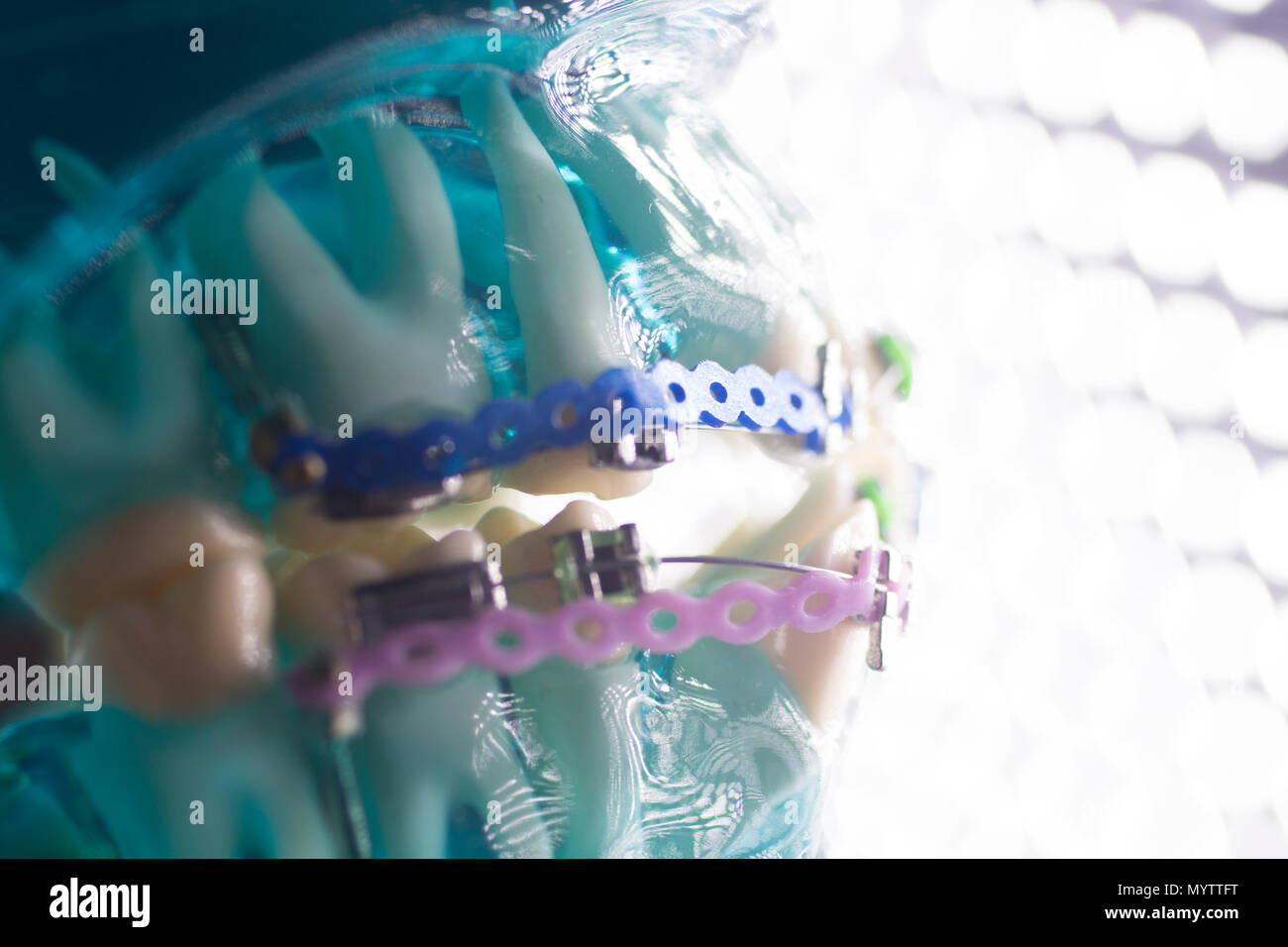 Dental teeth retainers metal aligners brackets to straighten teeth in ...