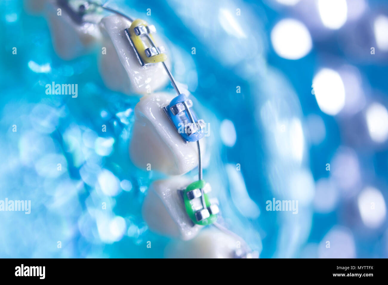 Dental teeth retainers metal aligners brackets to straighten teeth in ...