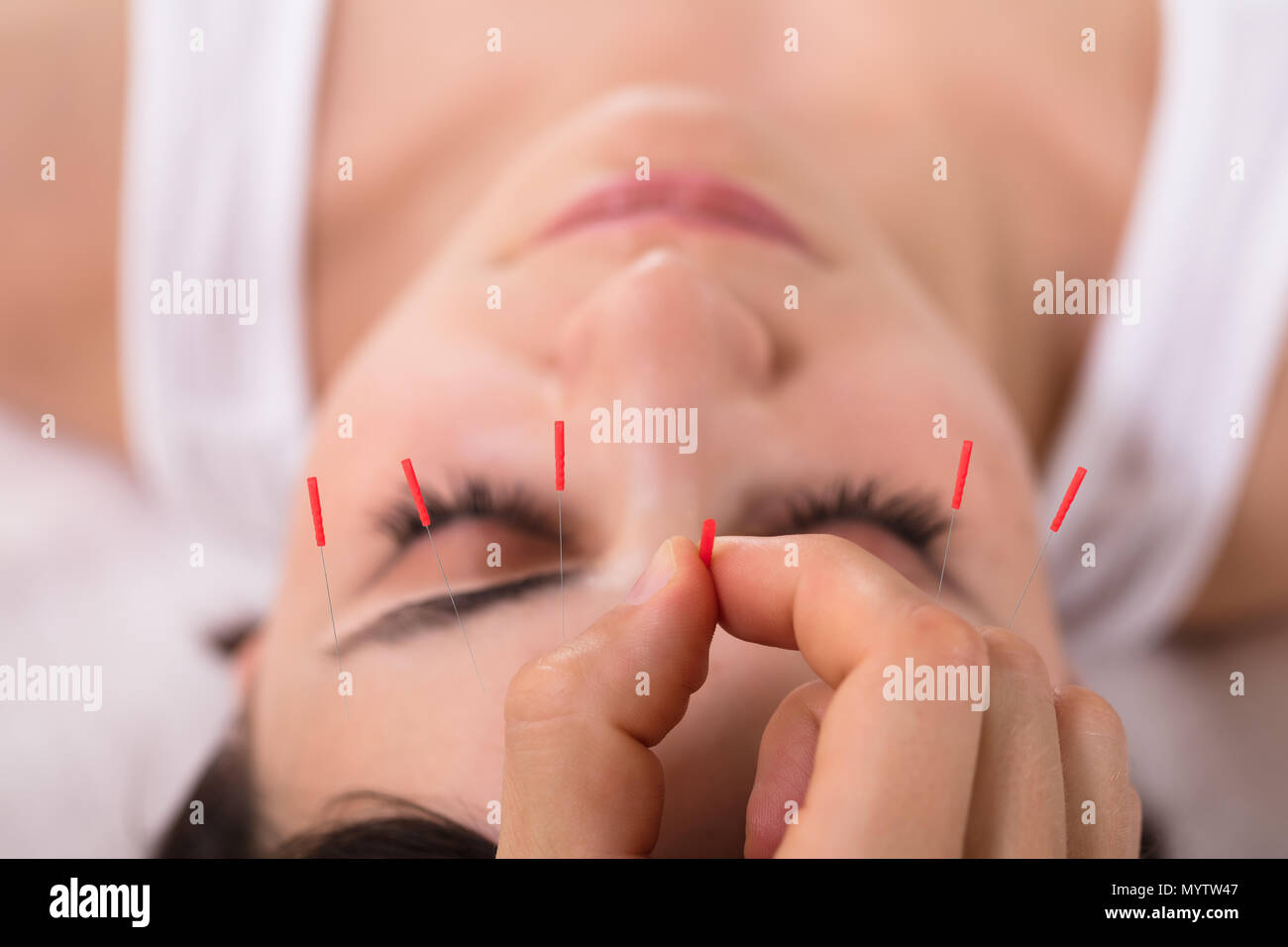 Acupuncture procedure hi-res stock photography and images - Alamy