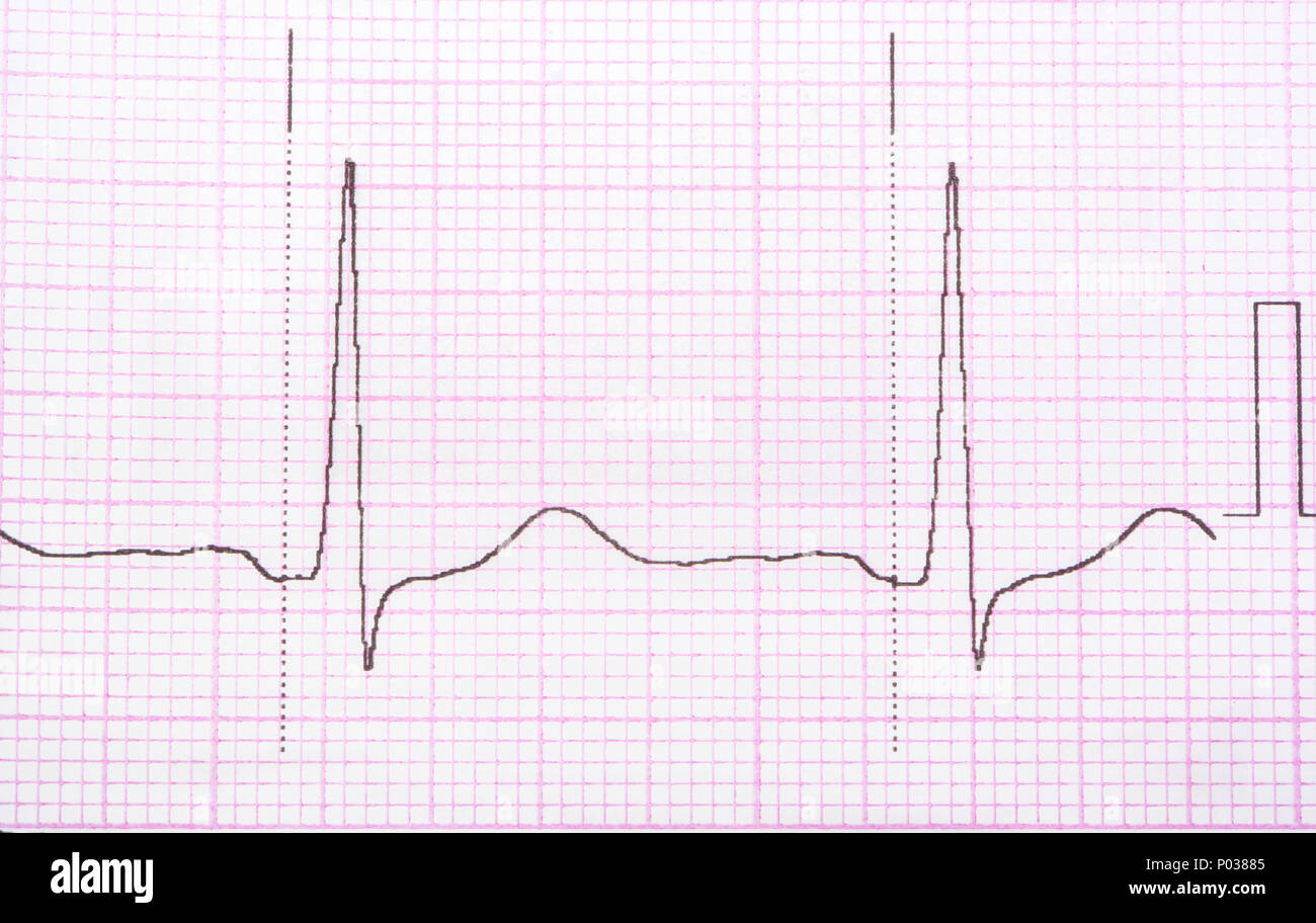 Snapshot cardiogram with the rhythm of heartbeats Stock Photo - Alamy