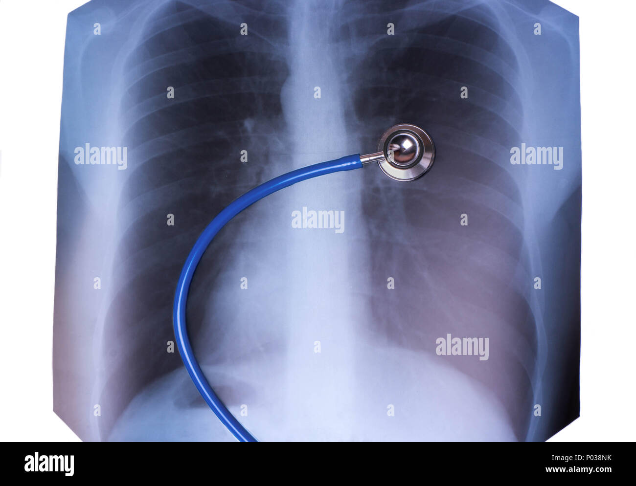 Healthy Lungs X Ray Stock Photos & Healthy Lungs X Ray Stock Images - Alamy