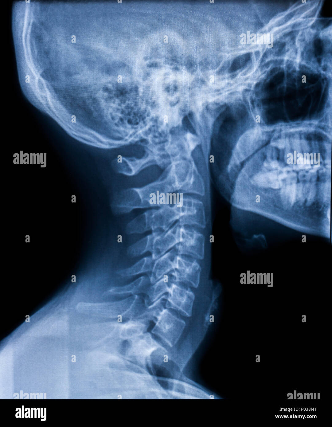 X ray man neck hi-res stock photography and images - Alamy