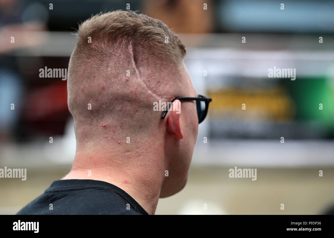 Detail of a scar of Former boxer Nick Blackwell during the weigh-in at ...