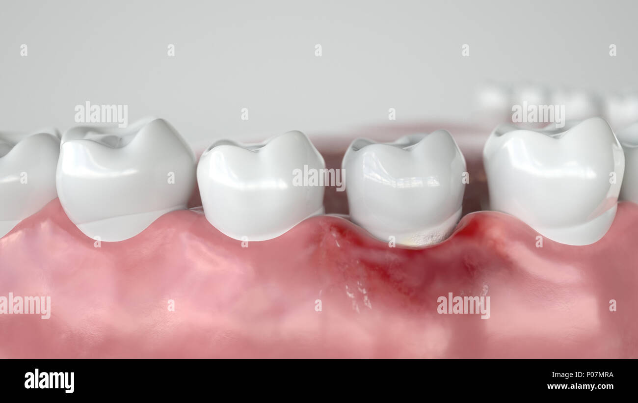 Caries in three stages - Stage 1 Gingivitis - 3D Rendering Stock Photo ...