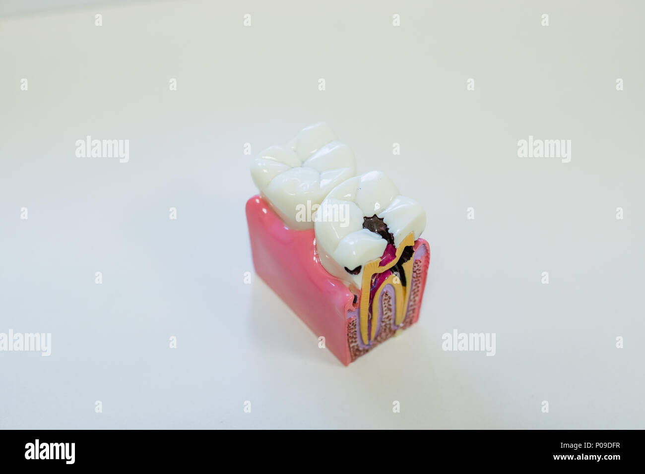 Dental model present common dental disease such as caries, wisdom tooth ...