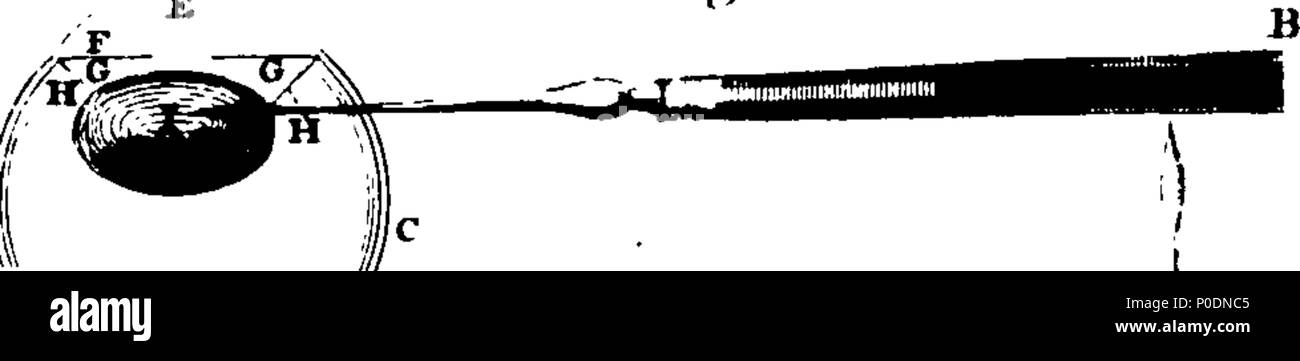 Cataract surgery couching hi-res stock photography and images - Alamy