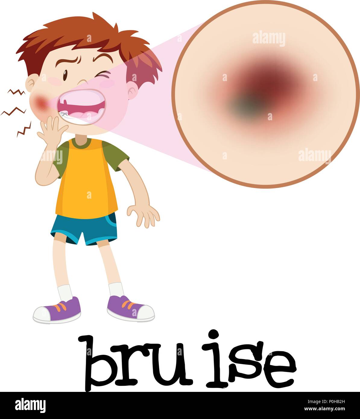 Red bruise Stock Vector Images - Alamy