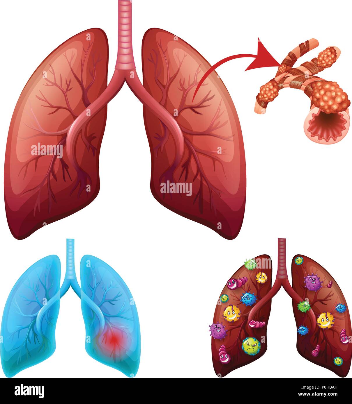 Lung cancer drawing hi-res stock photography and images - Alamy
