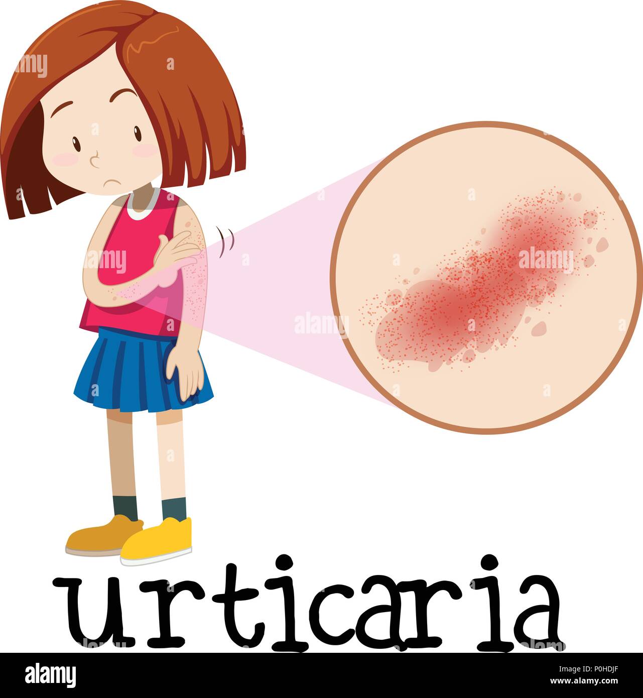 Urticaria Stock Photos & Urticaria Stock Images - Alamy